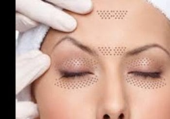 Entradas Plasma Pen bleferoplastia sin cirugia en párpados, ojera ...